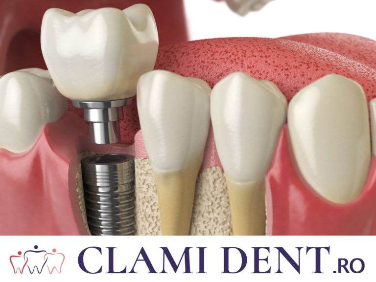 Totul Despre Implanturile Dentare CLAMI DENT ALBA IULIA