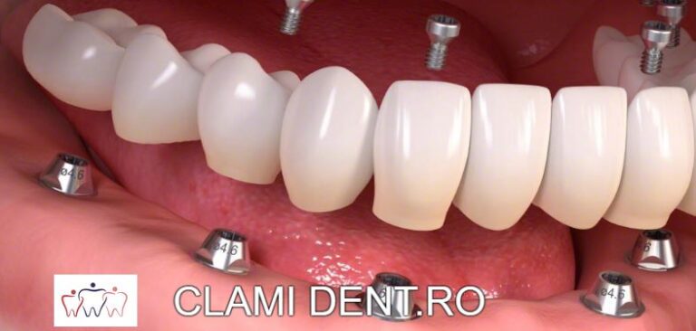 IMPLANTURI DENTARE: Arta Restaurării Zâmbetului la Clami Dent - Clinica ...