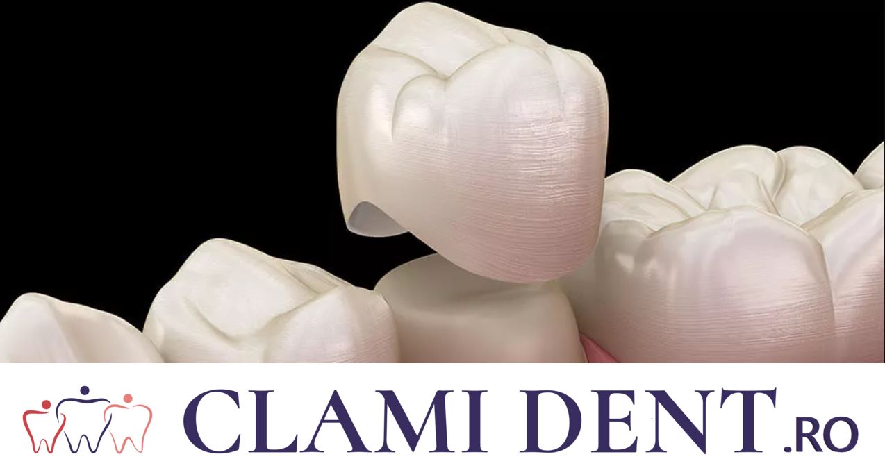 Coroane Dentare Alba Iulia: Ghid Complet Pacienții ClamiDent